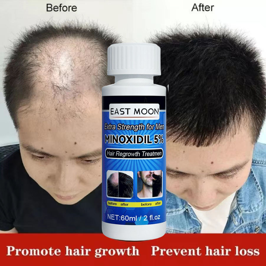Jual MINOXIDIL 5% Obat penumbuh rambut penumbuh rambut cepat serum ...