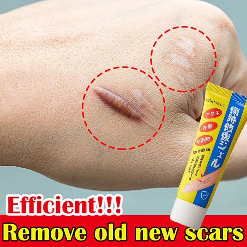 Jual KORMESIC Scar Gel 40gr - Cream Penghilang Bekas Luka - Bekas ...
