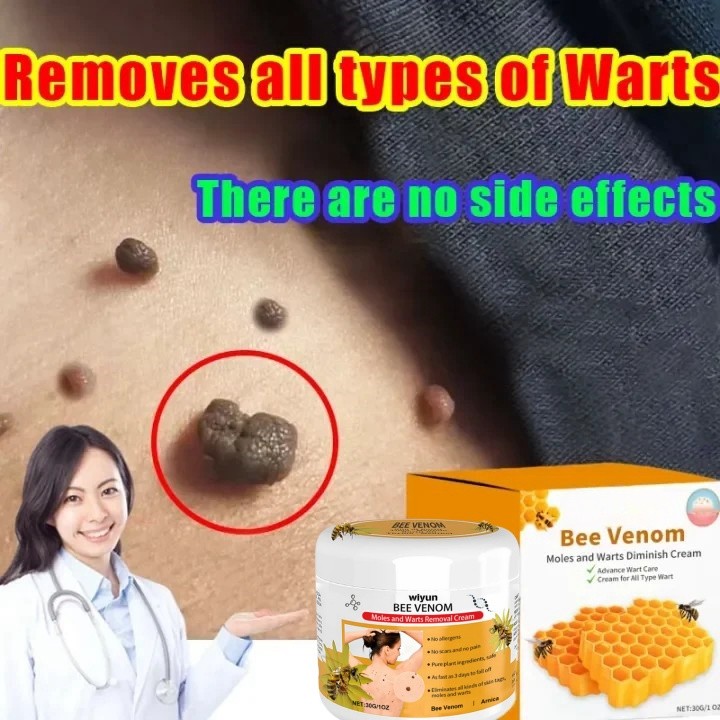 Jual Salep Obat Kutil Paling Ampuh Wart Remover Bee Venom Penghilang ...