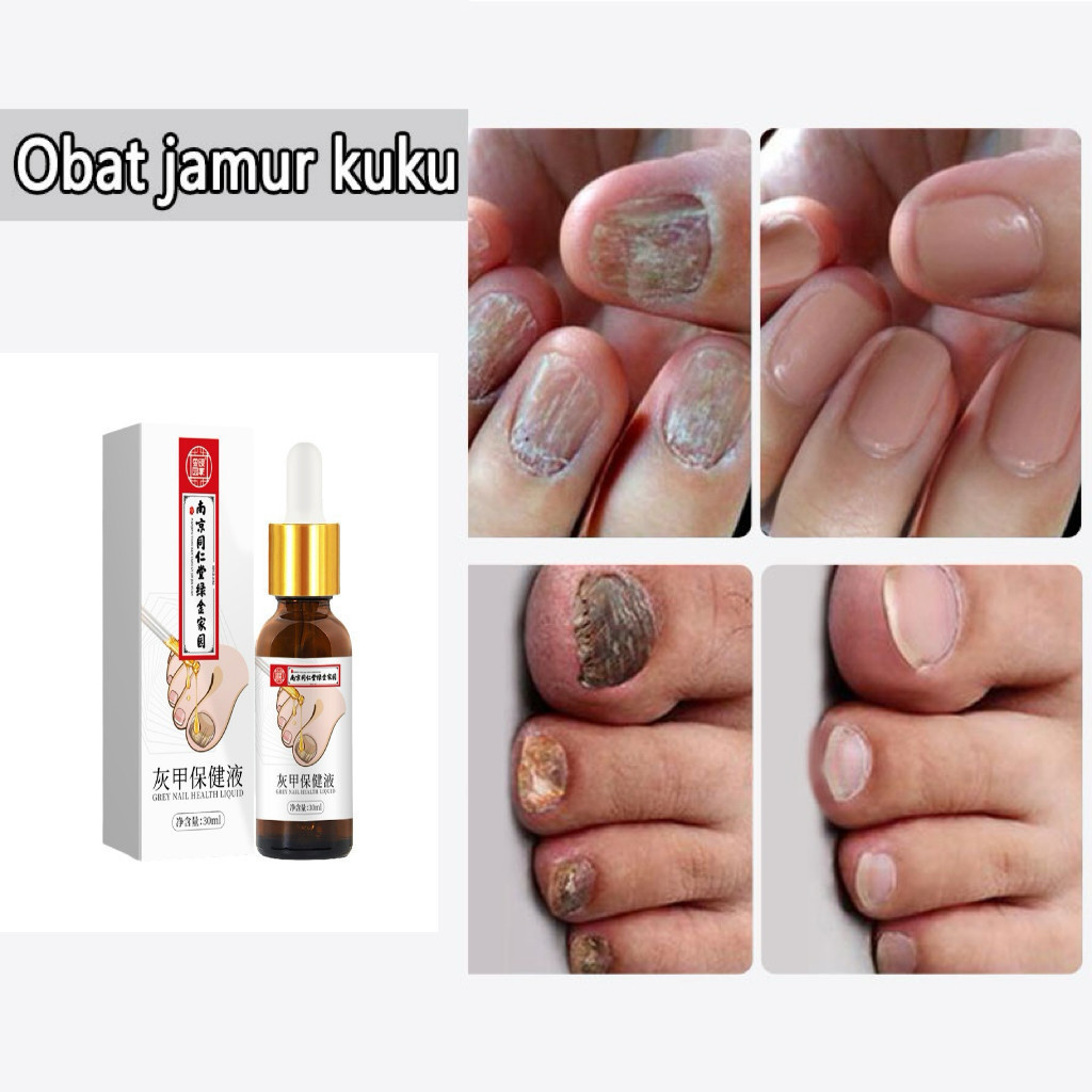 Jual Perawatan Kuku Onikomikosis Paronychia Anti Infeksi Kuku Toe Nail ...