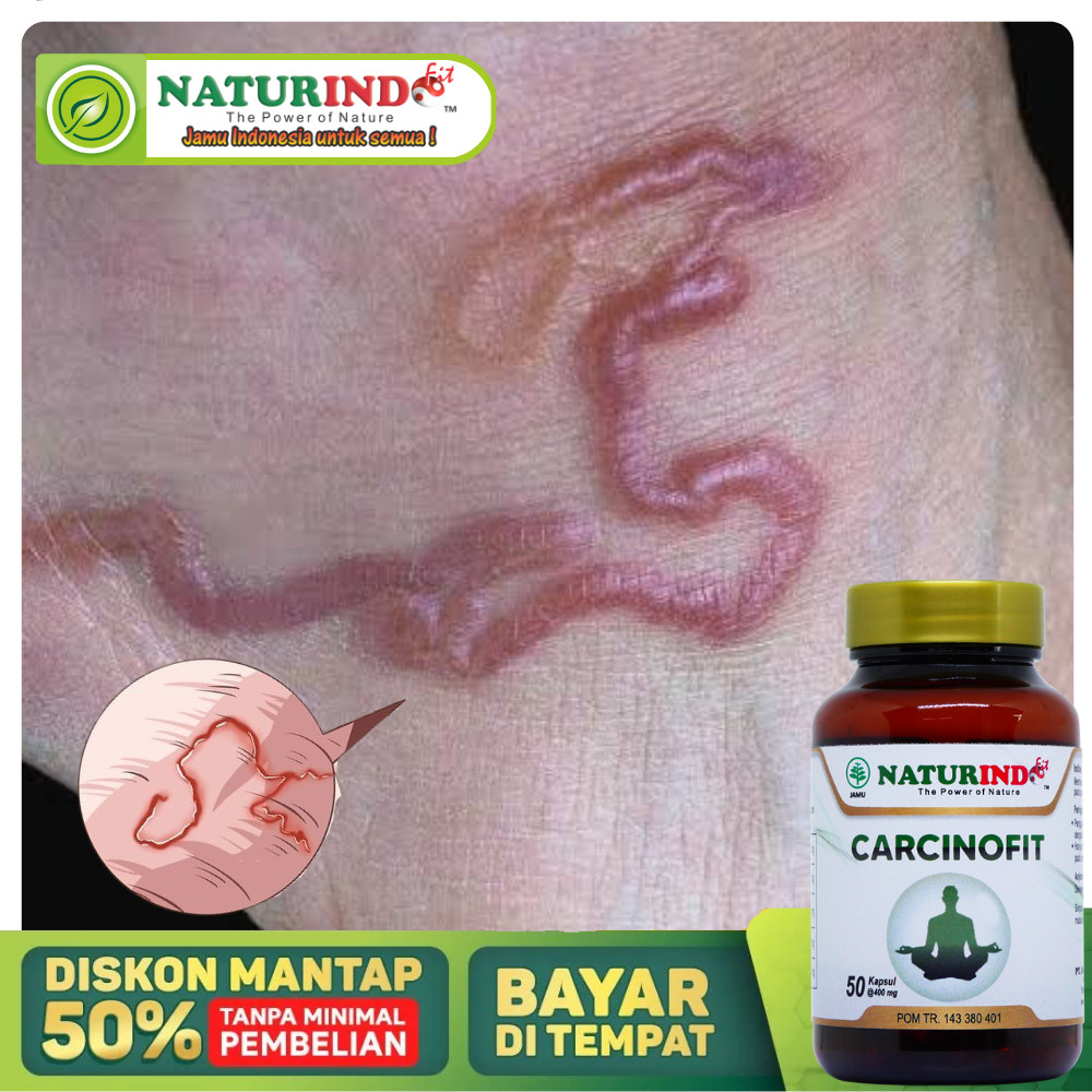 Jual Obat Cacing Pasir Kulit Paling Ampuh, Obat Larva Cacing Pasir ...