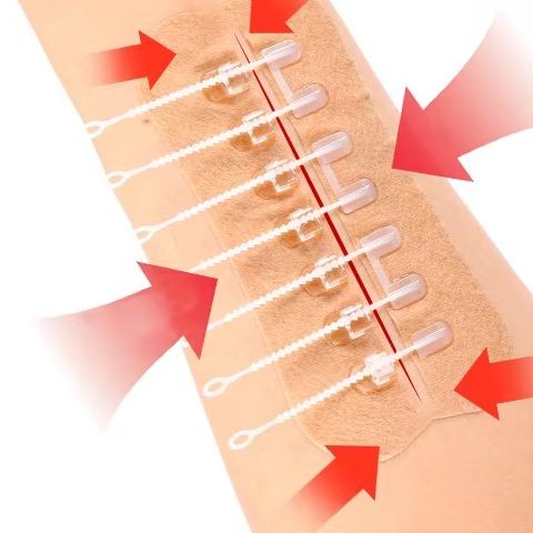 Jual Zipper Tie Wound Closure Patch Hemostatic Patch Wound Fast Without ...