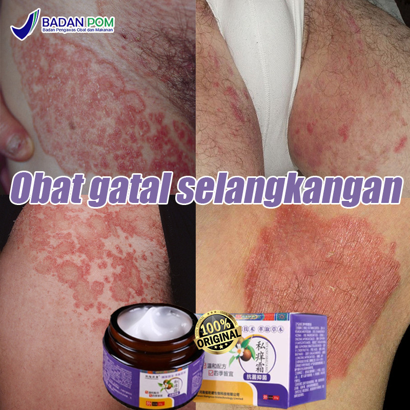 Jual salep gatal paling ampuh salep gatal obat gatal selangkangan obat ...