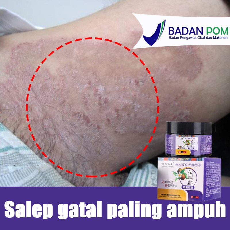 Jual Salep gatal paling ampuh Obat psoriasis obat gatal salep kutil ...
