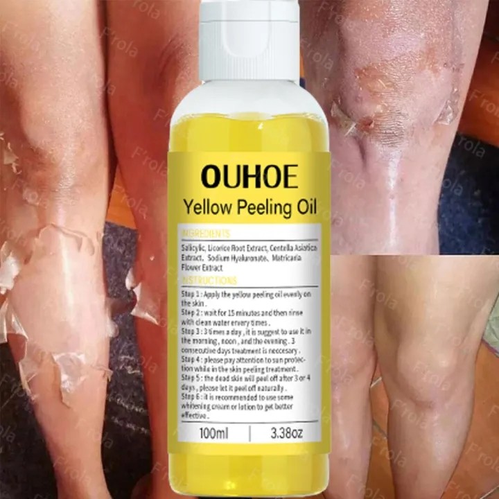 Jual OUHOE Yellow Peeling Oil 100ml Skin Peeling Body Peeling For ...