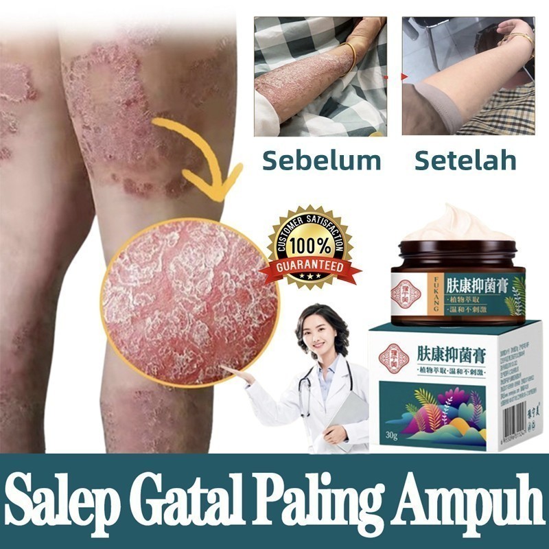 Jual salep gatal paling ampuh salep eksim Obat psoriasis Anti jamur ...