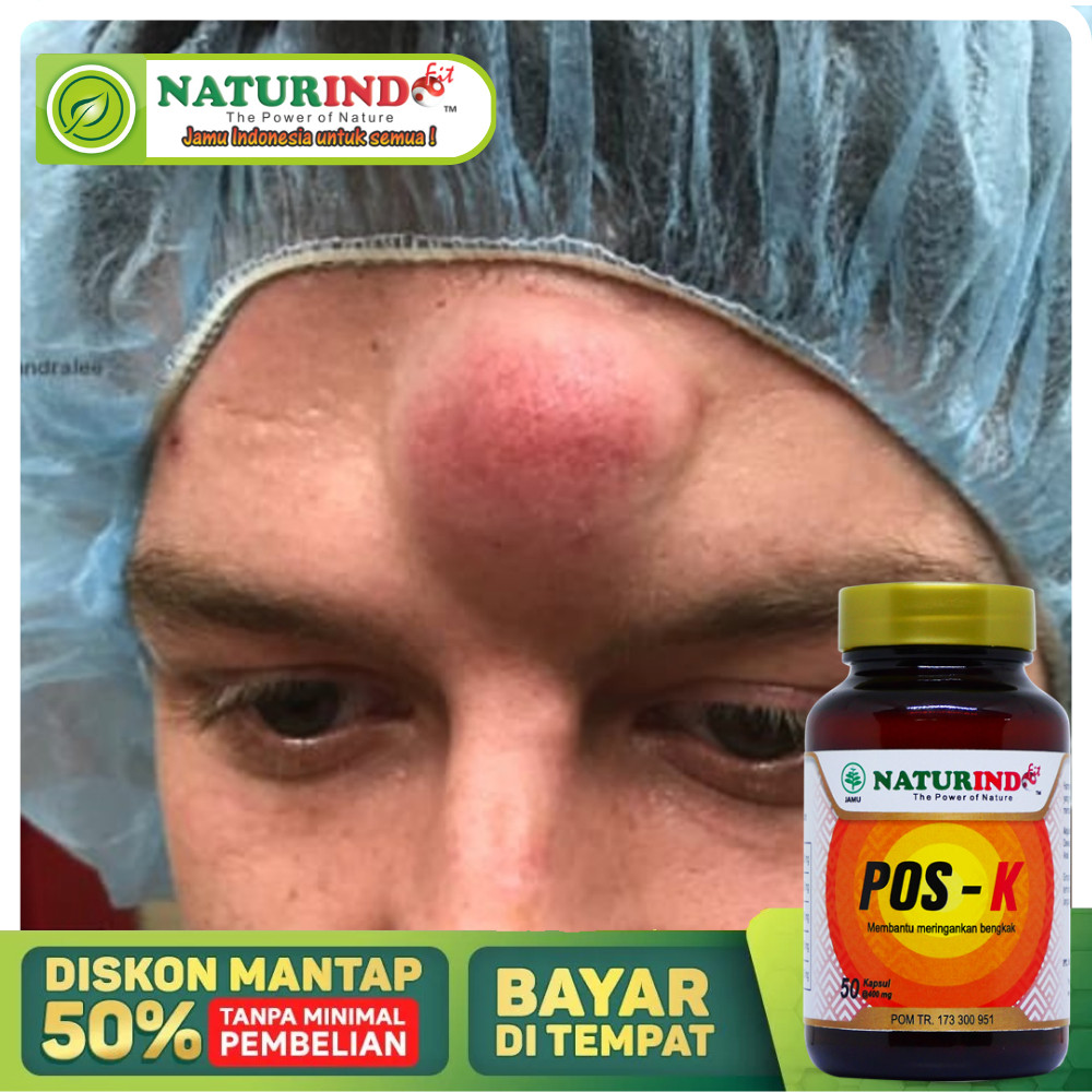 Jual Obat Benjolan di Dahi, Penghilang Benjolan di Dahi, Benjolan di ...