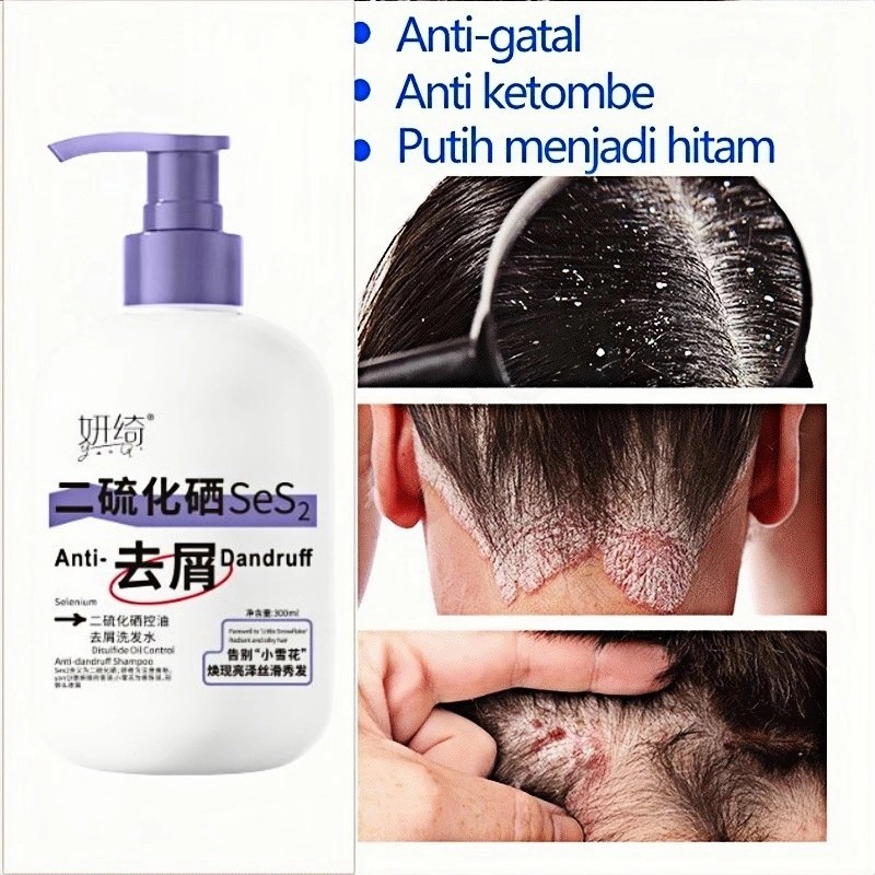Jual 300ML Scalp ringworm shampoo anti-dandruff shampoo oil control ...