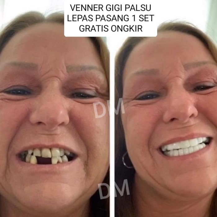 Jual KUAT BUAT MAKAN!!!!! Gigi palsu lepasan atas bawah Venner Gigi ...