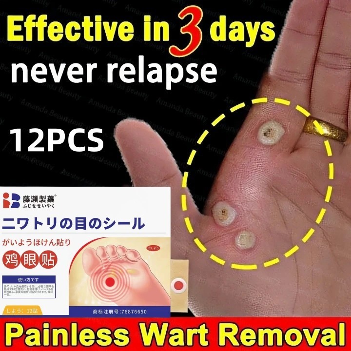 Jual Japan 12PCS Kapalan Corn Patch Removal Obat Kutil Kapalan Mata ...