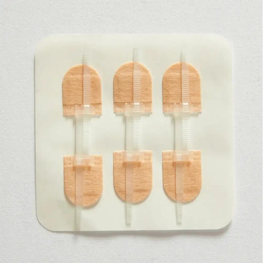 Jual Zipper Painless Wound Closure Device Suture-free Wound Dressing ...