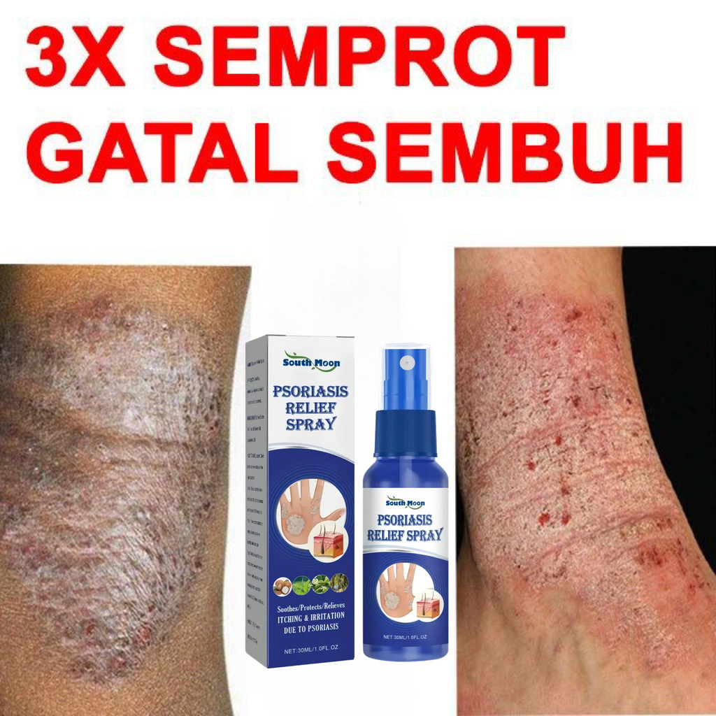Jual spray gatal Salep khusus psoriasis spray jamur kulit kurap pada ...