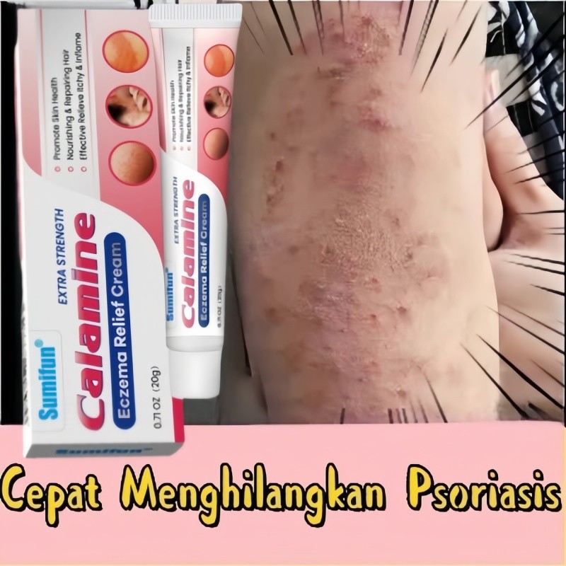 Jual Salep Gatal Paling Ampuh Obat Gatal Kulit Eczema Cream Untuk Orang ...