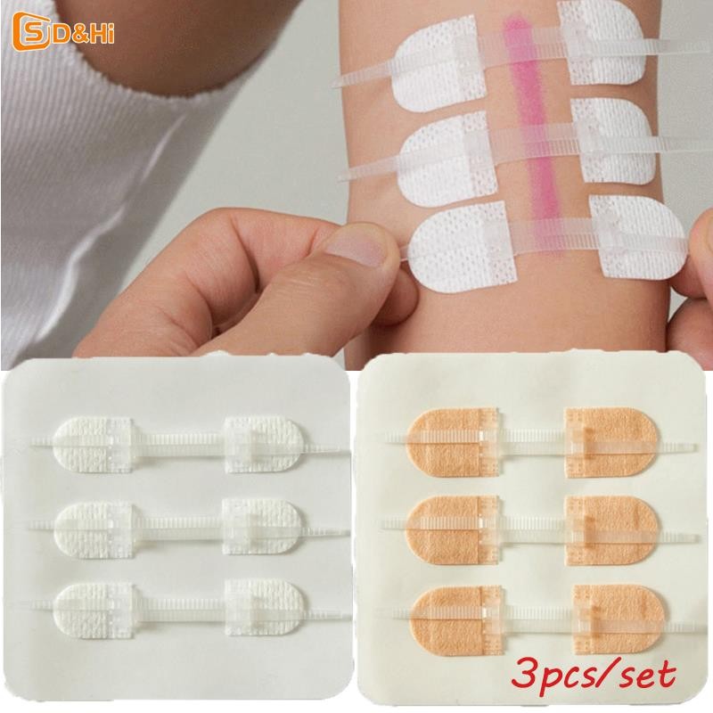 Jual Band-Aid Zipper Tie Wound Closure Patch Hemostatic Patch Wound ...