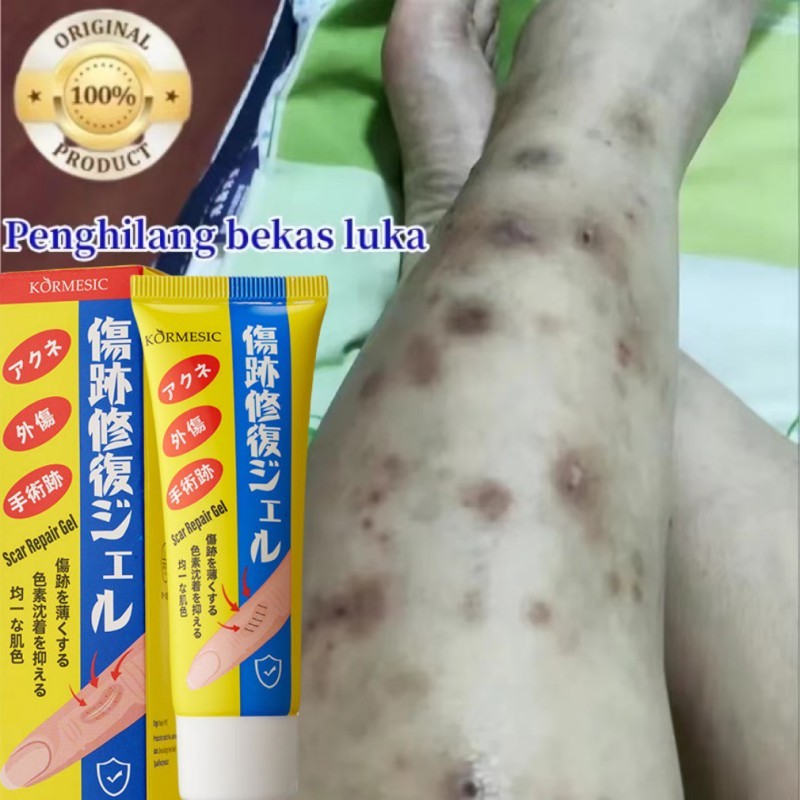 Jual KORMESIC Penghilang bekas luka hitam koreng Penghilang koreng di ...