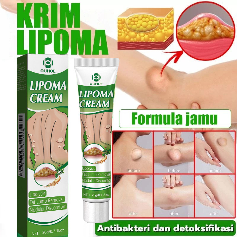 Jual Lipoma Cream Obat Benjolan Subkutan Lipoma Removal Cream Obat ...
