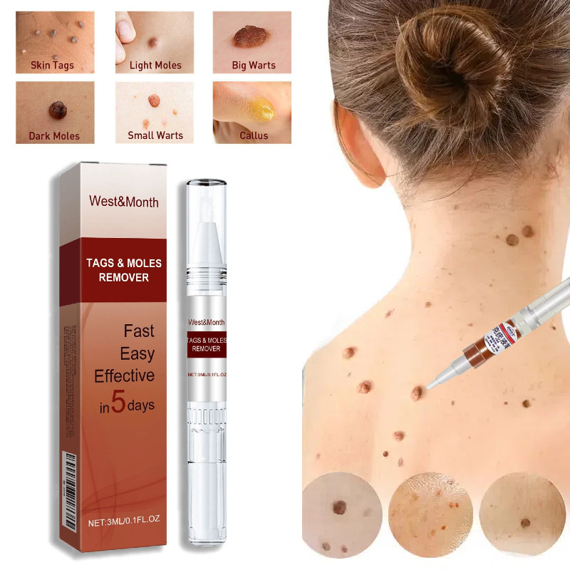 Jual Penghilang Tahi Lalat Penghilang Kutil Skin Tag Remover Penghilang ...
