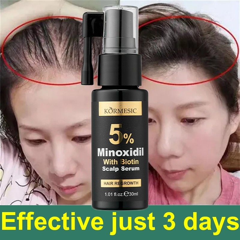 Jual Minoxidil Penumbuh Rambut Obat Penumbuh Rambut Botak, Tipis Dan ...