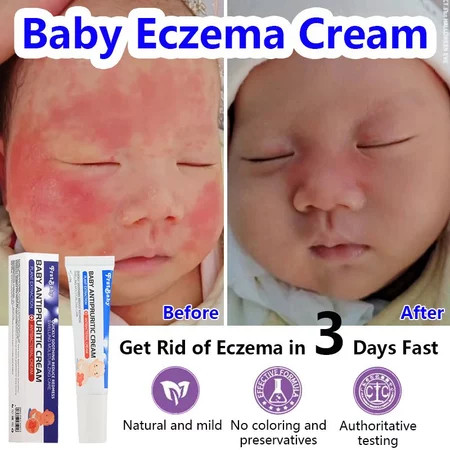 Jual VEROSAE_SHOP Salep eksim bayi Eczema cream bayi Obat eksim alergi ...