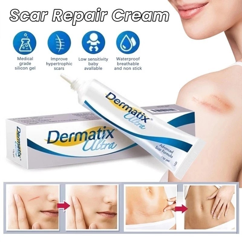 Jual Dermatix ultra original 100% 15gr Penghilang Bekas Luka Operasi ...