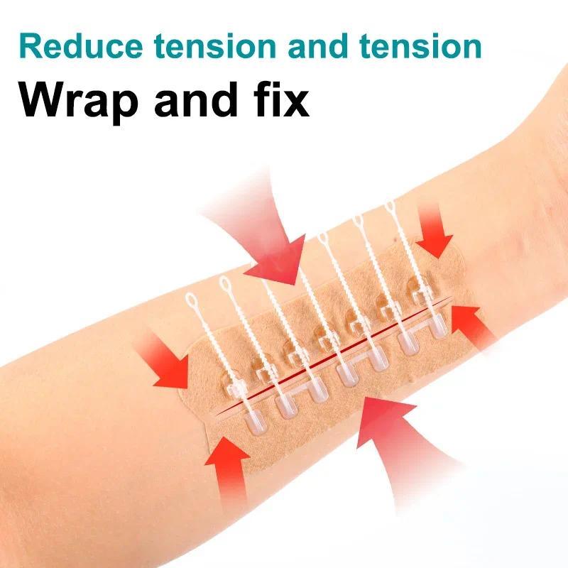 Jual Zip Stitch Sutures Skin Laceration Closures Adhesive Bandages ...