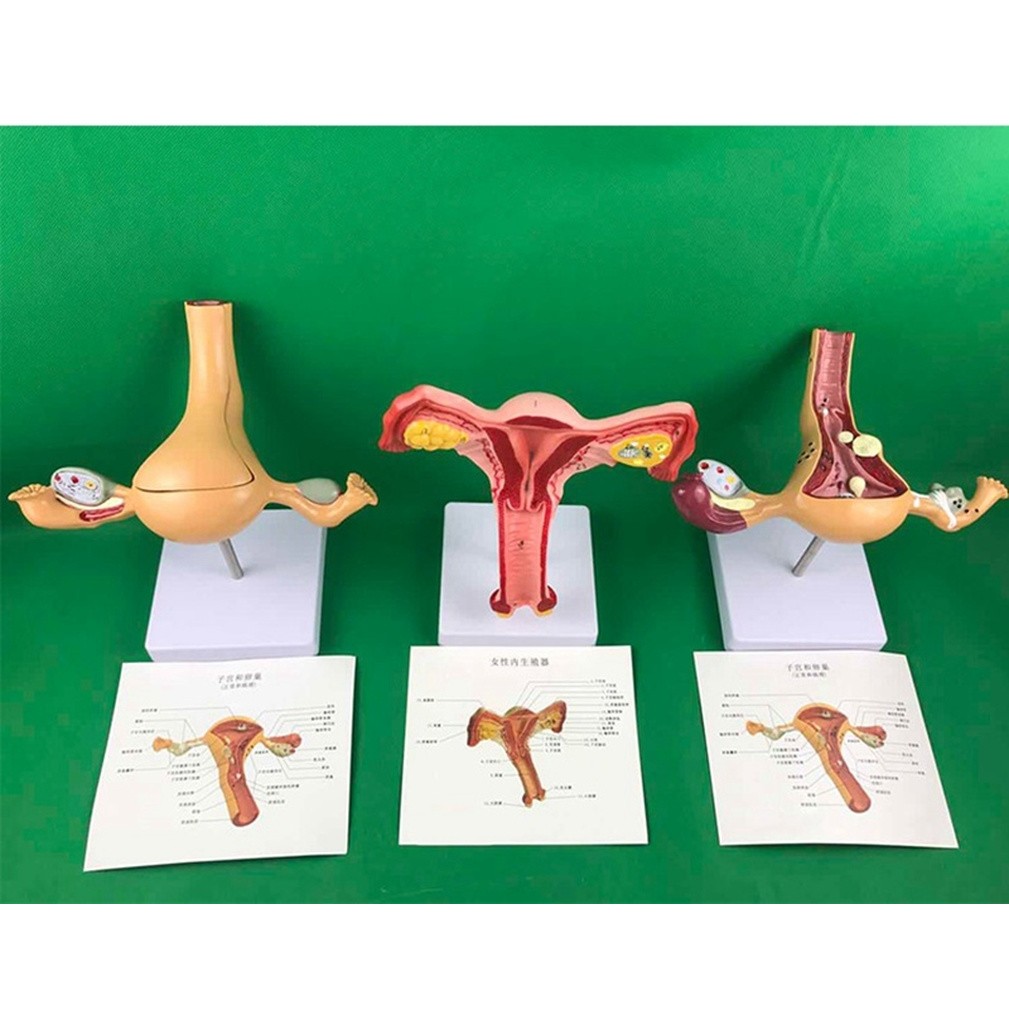 Jual Terbatas! Ovary and uterus disease Dissection model Pathology ...